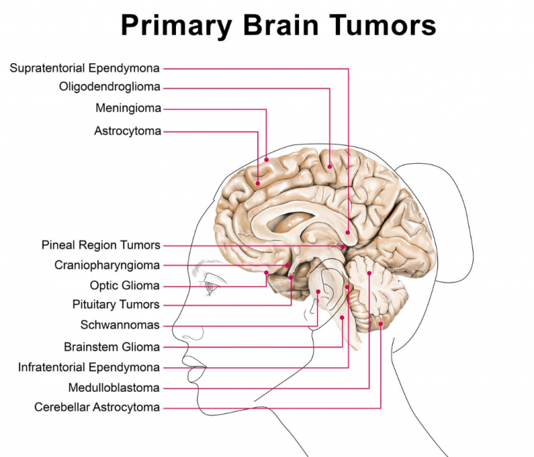 Brain Tumors and Common Myths: What We Can Learn from Jason Collins ...